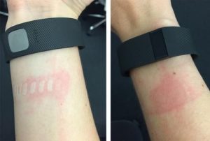 Fitness Tracker Rash - Wearable Fitness Trackers